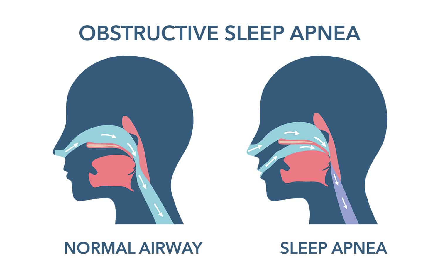 Sleep Solutions Conway, NH | Conway Village Dental